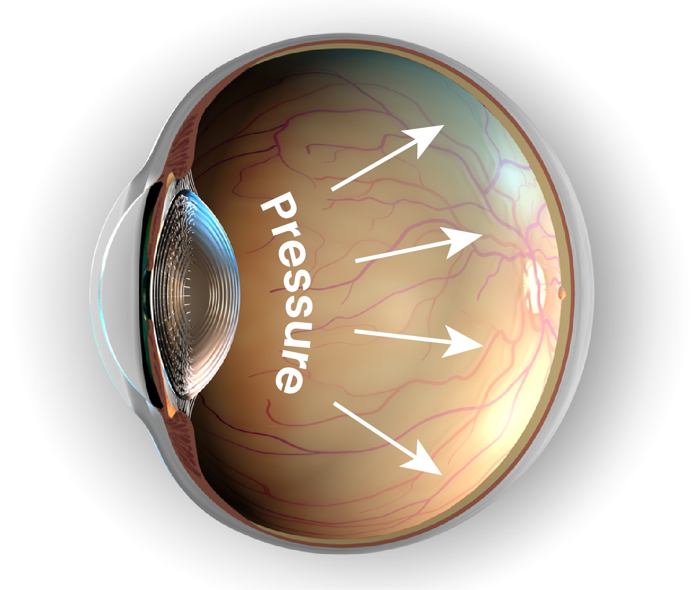 does glaucoma cause headaches - a Halma Company (UK)