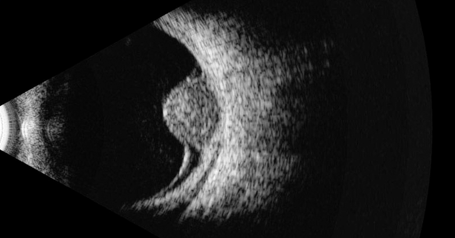 A guide to the most important ophthalmic ultrasound machines and ...